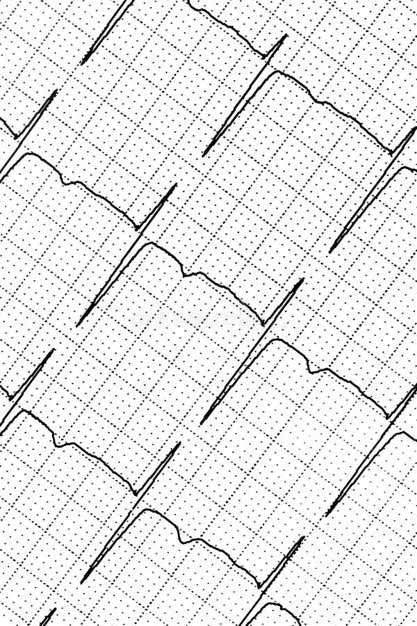 Electrocardiogram Test that Shows Electrical Activity of the Heart ...