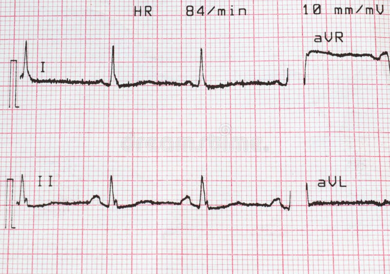 Electrocardiogram Test that Shows Electrical Activity of the Heart ...