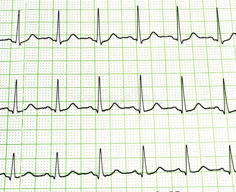 Electrocardiogram Test that Shows Electrical Activity of the Heart ...