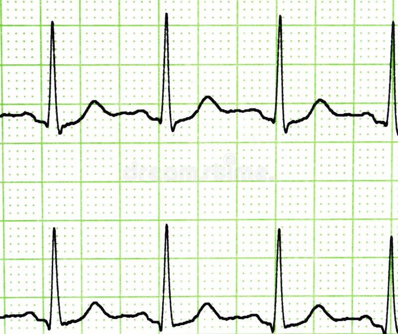 Electrocardiogram Test that Shows Electrical Activity of the Heart ...