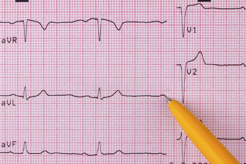 Electrocardiograma Sano Del Corazón Foto de archivo - Imagen de médico ...