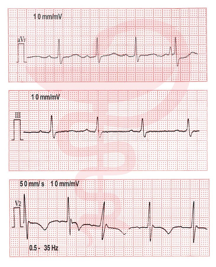 The Electrocardiograms with Medical Sign Stock Illustration ...