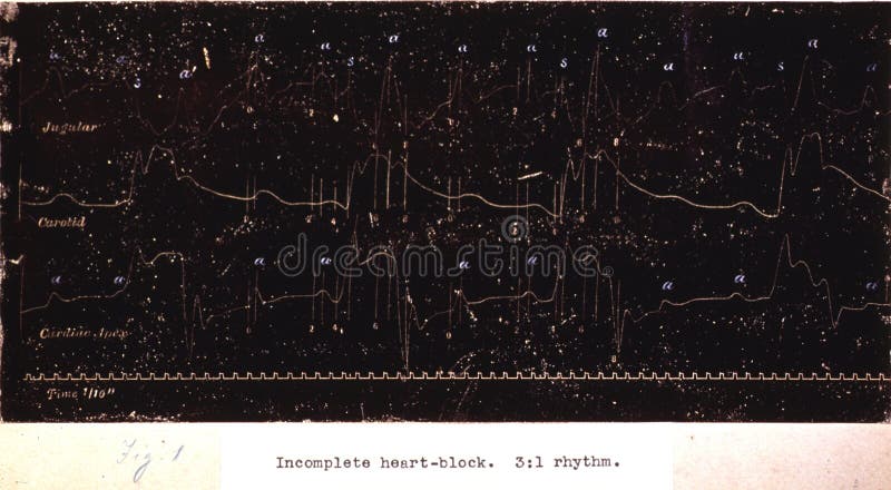 Electrocardiography: Graphs: Incomplete Heart Block. 3:1 Rhythm Picture ...