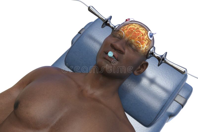 Electroconvulsive Therapy, ECT, a Treatment Involving the Use of ...
