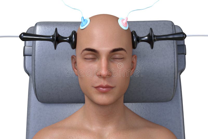 Electrical Stimulation Therapy Stock Illustrations – 57 Electrical ...
