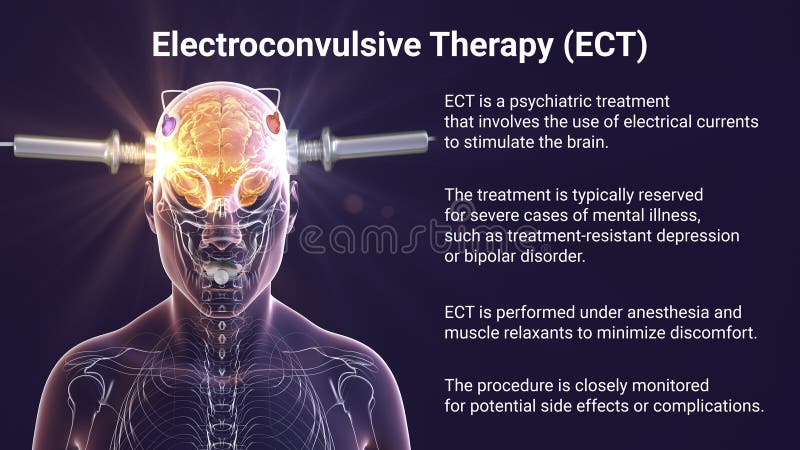 Electroconvulsive Therapy, ECT, a Treatment Involving the Use of ...