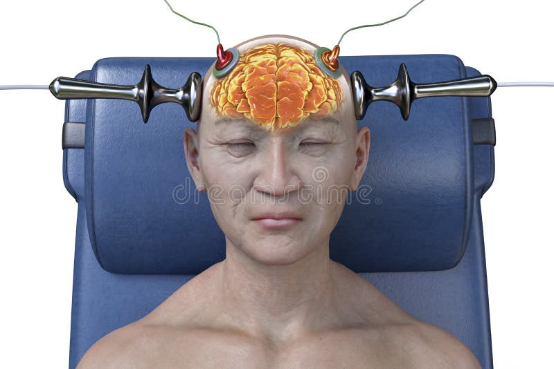 Electroconvulsive Therapy, ECT, a Treatment Involving the Use of ...