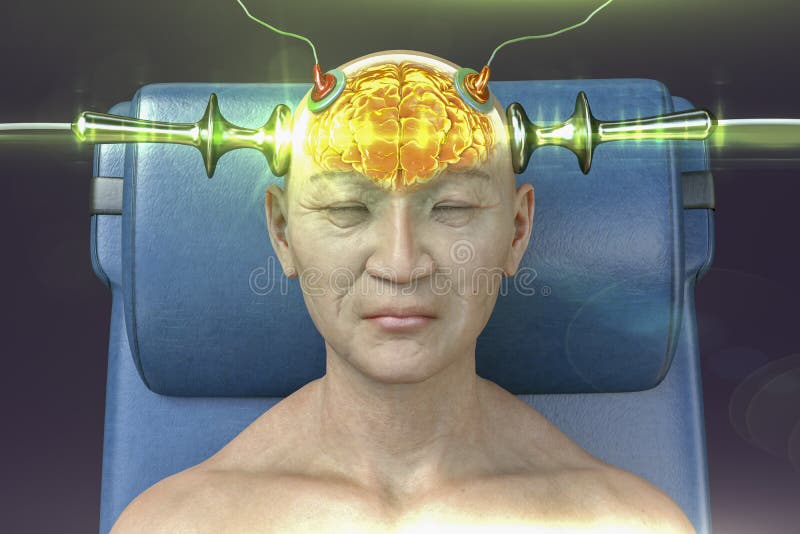 Electroconvulsive Therapy, ECT, a Treatment Involving the Use of ...