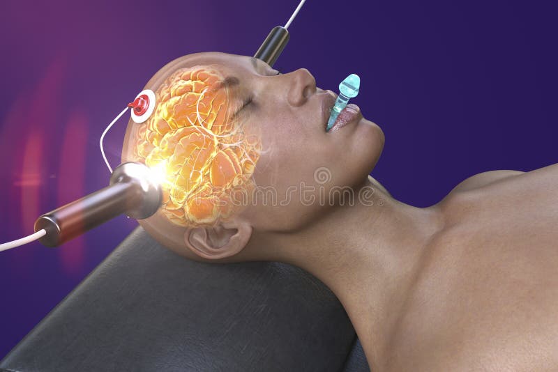 Electroconvulsive Therapy, ECT, a Treatment Involving the Use of ...