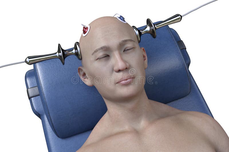 Electroconvulsive Therapy, ECT, a Treatment Involving the Use of ...