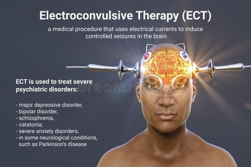 Electroconvulsive Therapy, ECT, a Treatment Involving the Use of ...