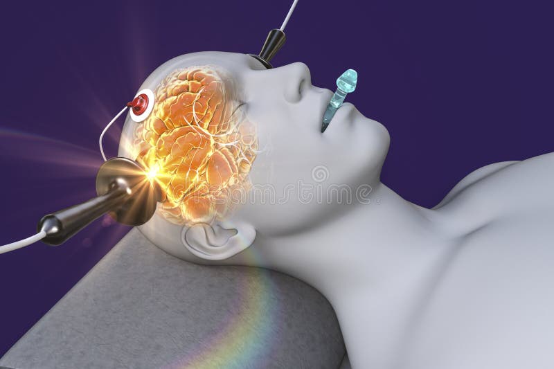 Electroconvulsive Therapy, ECT, a Treatment Involving the Use of ...