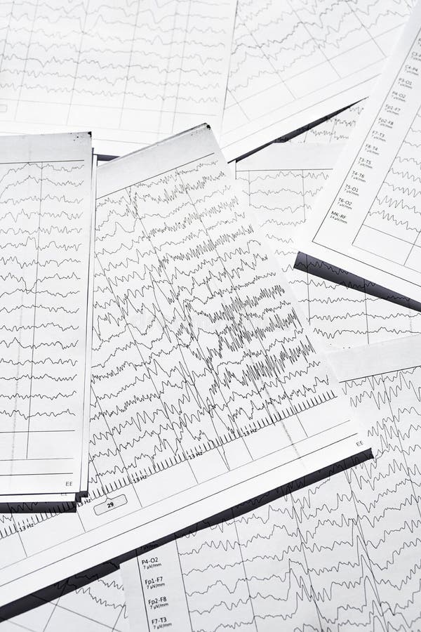 Electroencephalogram Diagnostic Rezults after Epilepsy. Brain Wave ...