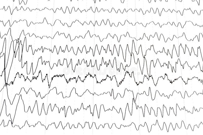 Subdural Grid Electrode for Brain Waves Recording or ...