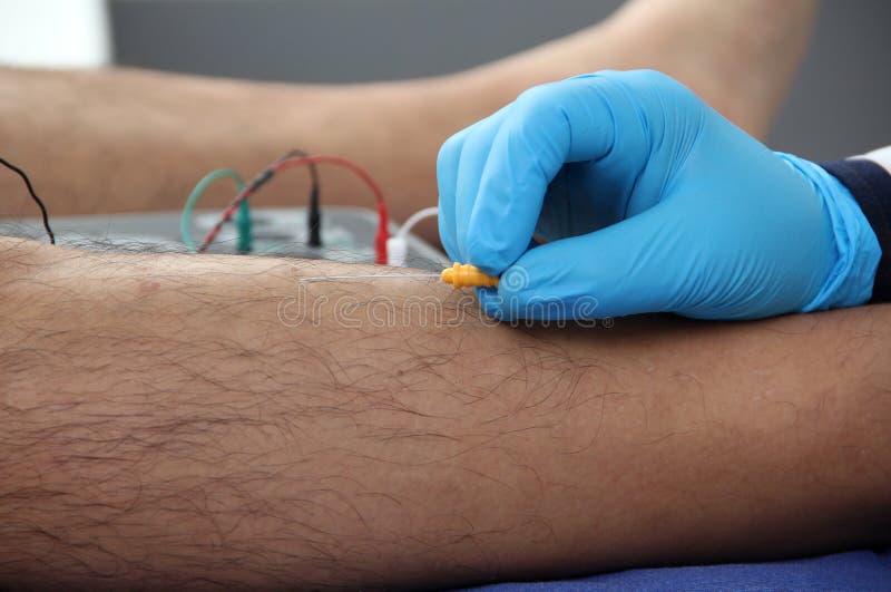 Electromyography Graphic Recording of the Electrical Activity Produced ...