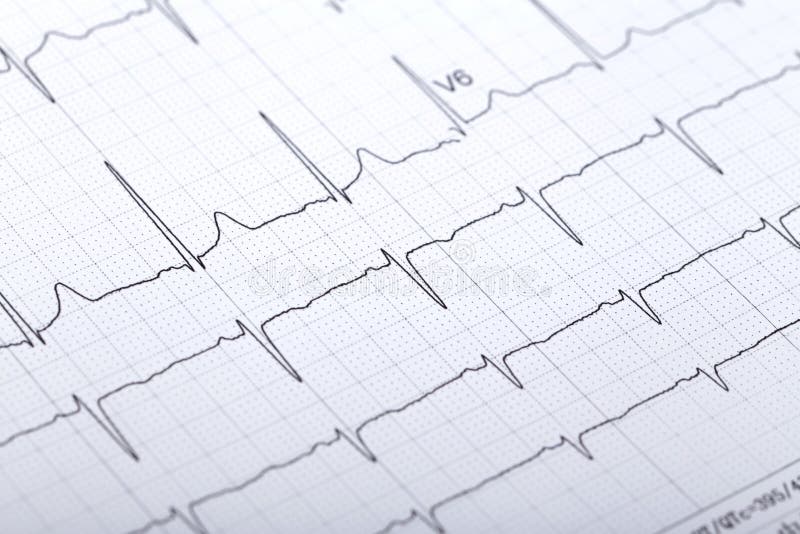 Elektrocardiogram stock afbeelding. Image of cardiograaf - 100468327