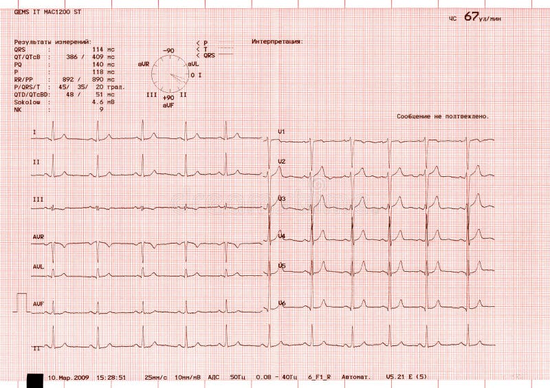 Elektrocardiogram stock illustratie. Illustratie bestaande uit meting ...