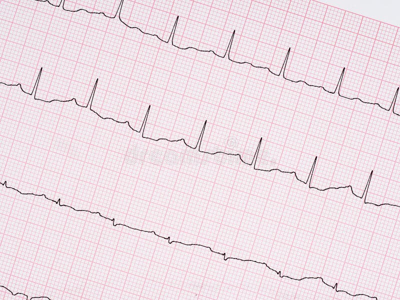 ECG, Elektrocardiogramdetail, Gezond Hartconcept Enz. Met Sm Stock ...