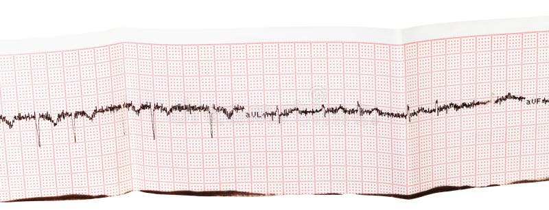 Electrocardiogram, Ecg Grafiek, Elektrocardiogram Ecg Op Papier Stock ...