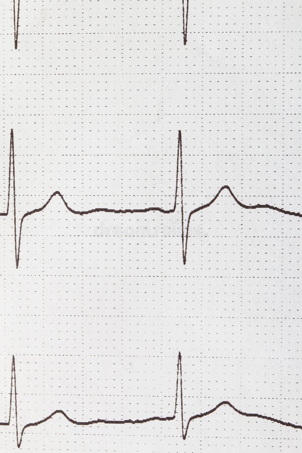 Elektrokardiogram Mapa Jako Medyczny Tło Obraz Stock - Obraz złożonej z ...