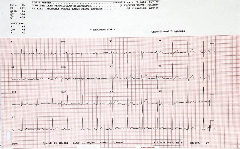 Elektrokardiogramm stockfoto. Bild von elektrokardiogramm - 12624476