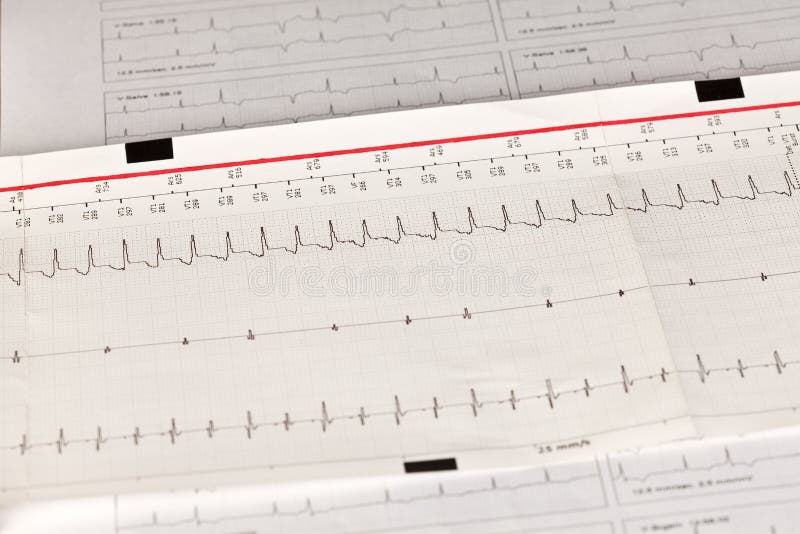Elektrokardiogramm ECG/EKG Mit Herzarrhythmie Stockbild - Bild von ...