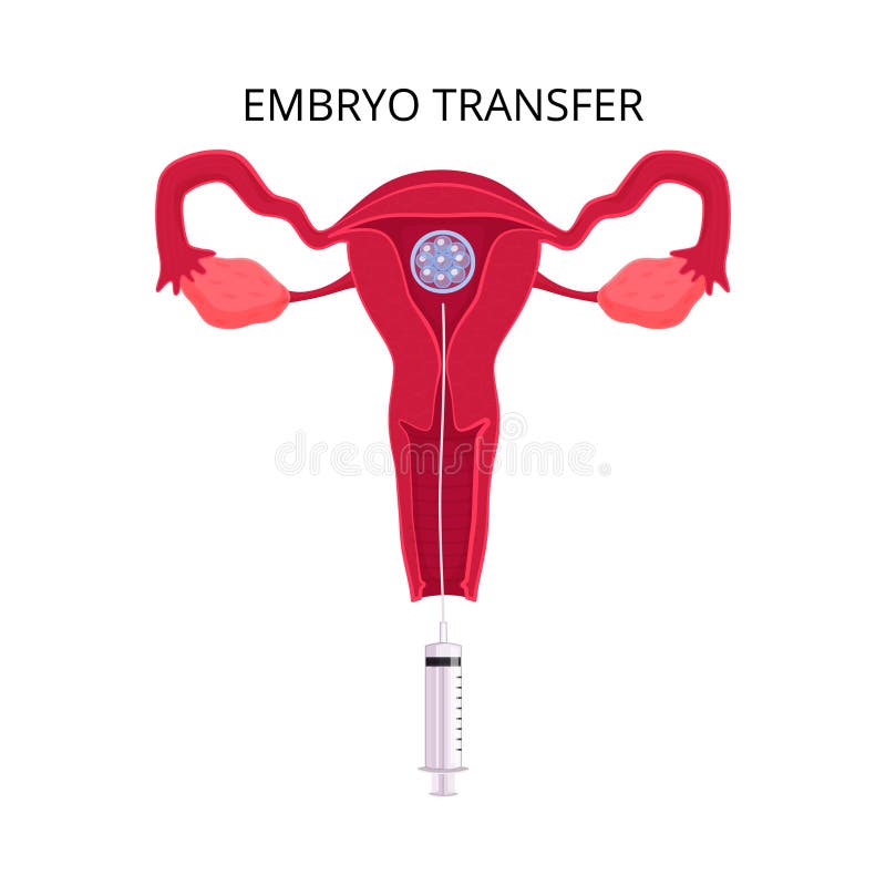 Embryo Transfer Flat Composition Stock Vector - Illustration of donor, pregnancy: 269777503