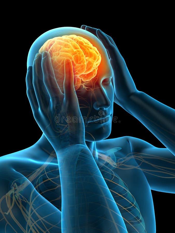 Emicrania Con Cefalea . Un'immagine Con Trigger Che Causano Emicranie ...