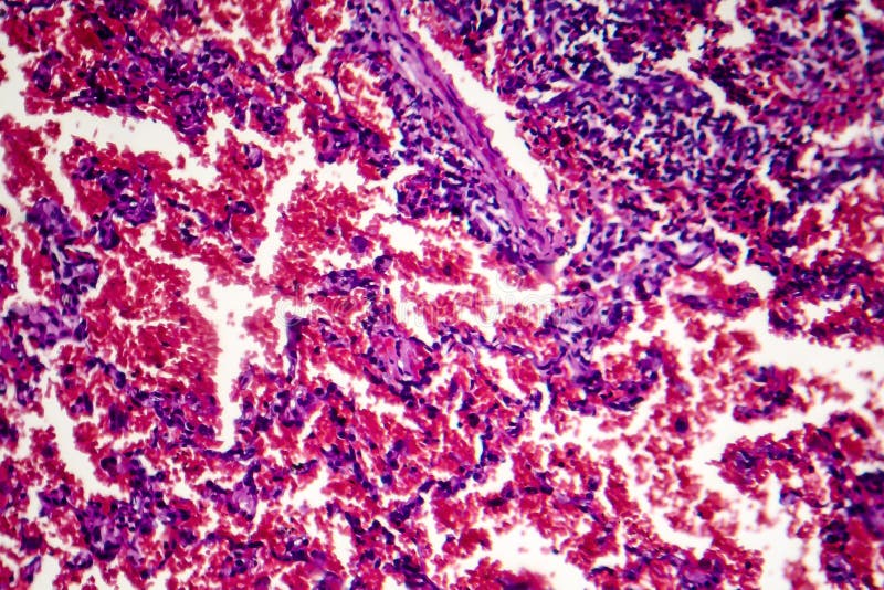 Edema polmonare acuto fotografia stock. Immagine di edema - 120906780