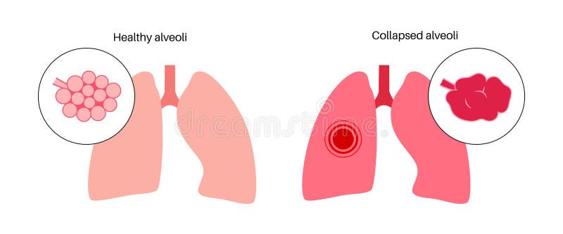 System Emphysema Stock Illustrations – 1,308 System Emphysema Stock ...