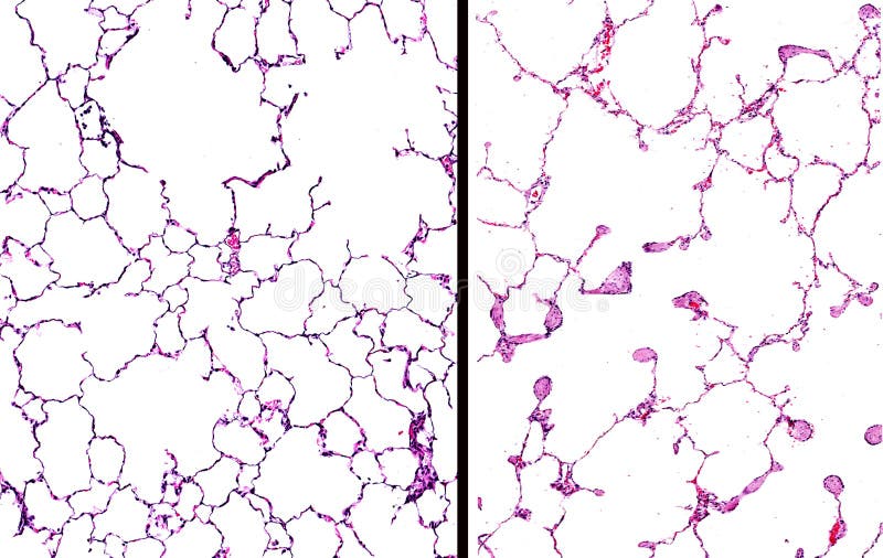 647 Alveoli Stock Photos - Free & Royalty-Free Stock Photos from Dreamstime