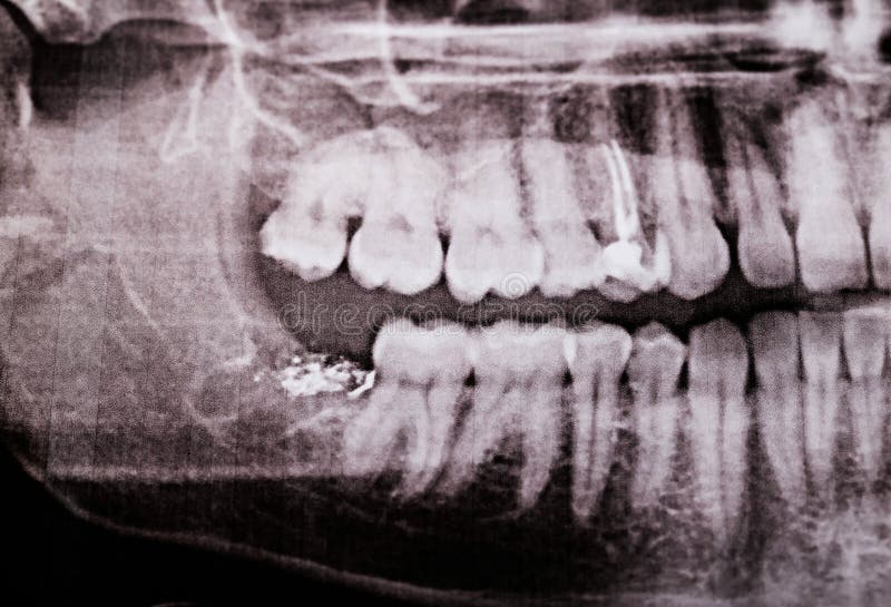 Empty Tooth Socket with Medicine after Wisdom Tooth Removal on X-ray ...