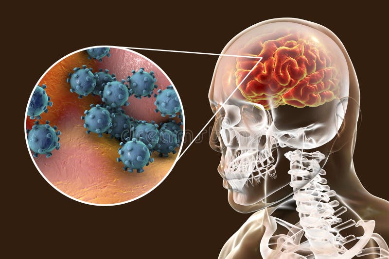 Méningite Et Encéphalite Virales, Concept Médical Illustration Stock ...