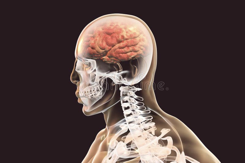 Brain Edema Stock Illustrations – 20 Brain Edema Stock Illustrations ...