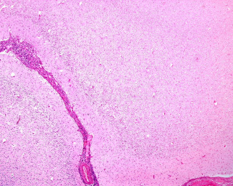 Encephalitis by Haemophilus Influenzae Stock Photo - Image of pathology ...