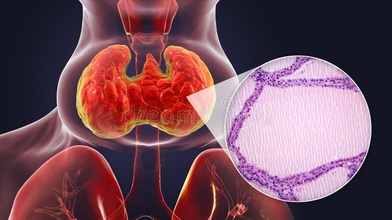 Endemic Goiter, 3D Illustration and Light Micrograph Stock Illustration ...