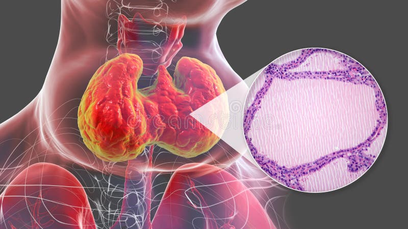 Endemic Goiter, 3D Illustration and Light Micrograph Stock Illustration ...