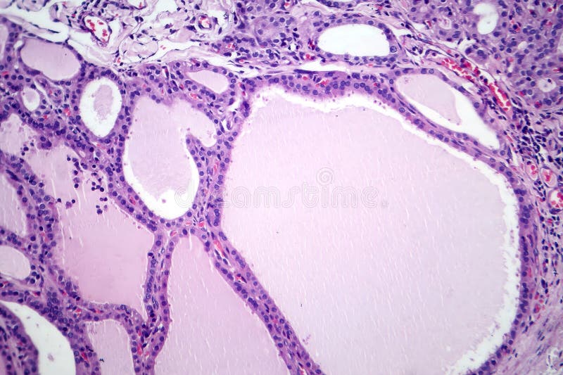 Endemic Goiter, Light Micrograph Stock Image - Image of cells, thyroid ...