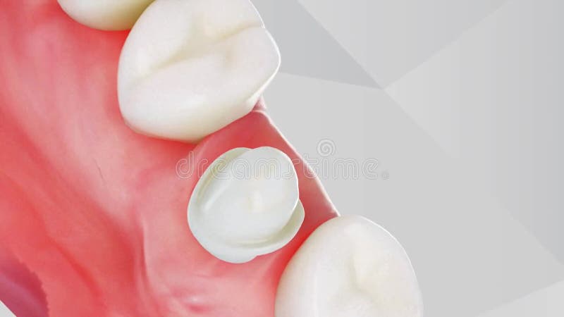 Endodontic Root Canal Treatment Process. Medically Accurate Tooth 3D ...