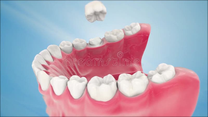 Endodontic Root Canal Treatment Process. Medically Accurate Tooth 3D ...