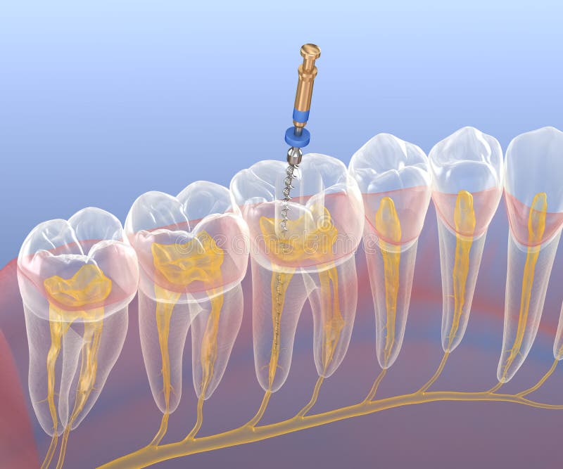 Endodontic Root Canal Treatment Process. Medically Accurate Tooth 3D ...