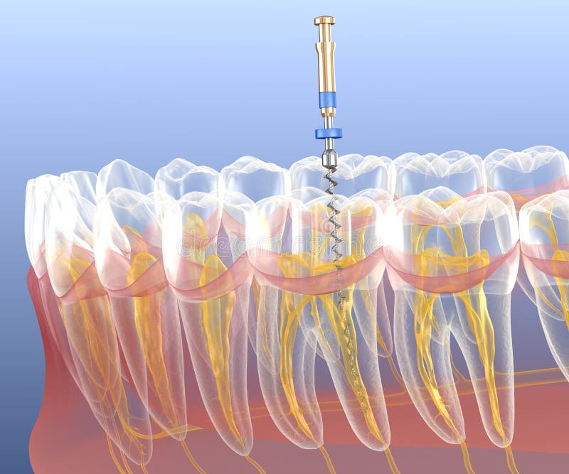 Endodontic Root Canal Treatment Process. Medically Accurate Tooth 3D ...