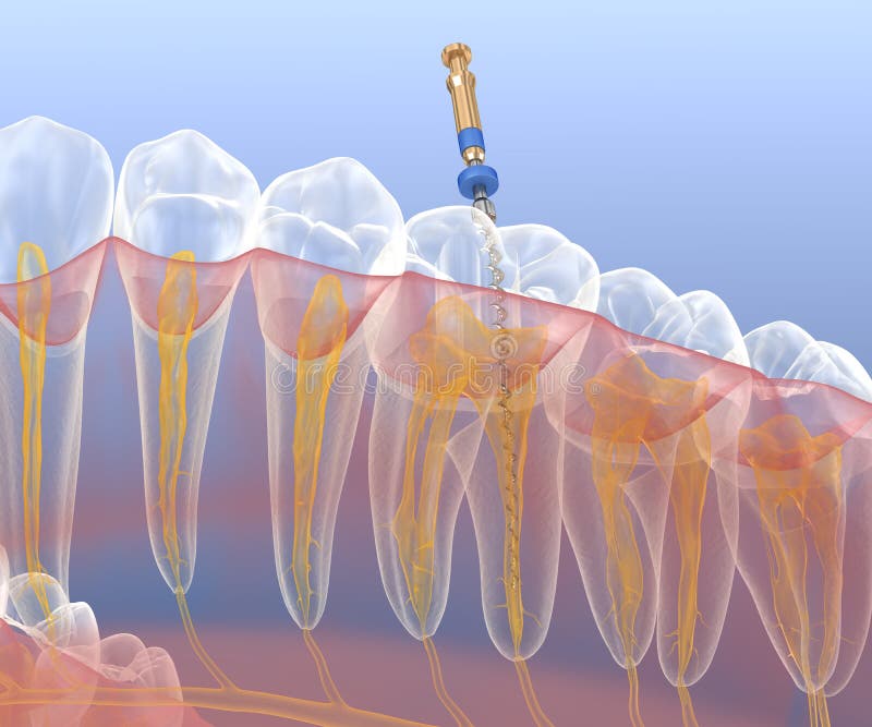 Endodontic Root Canal Treatment Process. Medically Accurate Tooth 3D ...