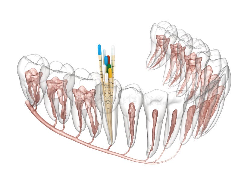 Endodontic Root Canal Treatment Process. Medically Accurate Tooth 3D ...