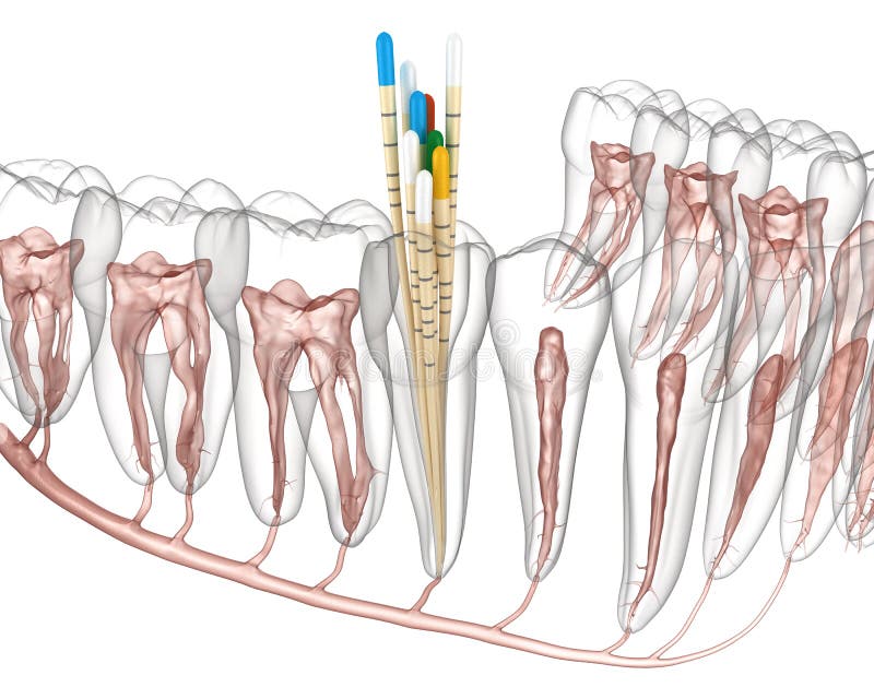 Endodontic Root Canal Treatment Process. Medically Accurate Tooth 3D ...