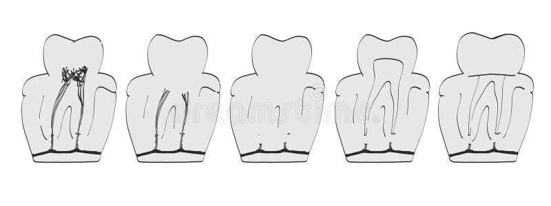 Endodontics - Root Canal Procedure Stock Illustration - Illustration of ...