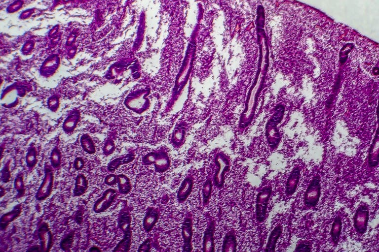 Endometrial Hyperplasia, Light Micrograph Stock Image - Image of ...