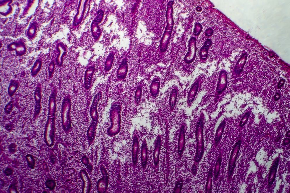 Endometrial Hyperplasia, Light Micrograph Stock Image - Image of ...