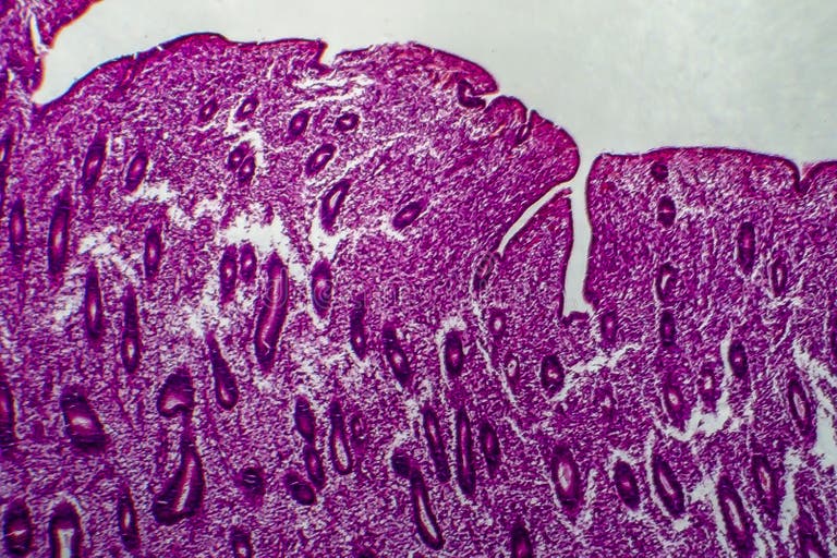 Endometrial Hyperplasia, Light Micrograph Stock Image - Image of tissue ...