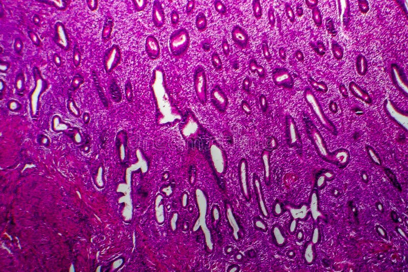 Endometrial Hyperplasia, Light Micrograph Stock Photo - Image of ...
